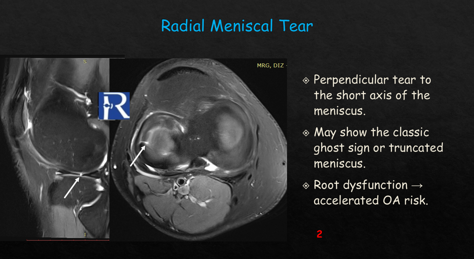 Meniscal Tears – Comprehensive MRI Guide