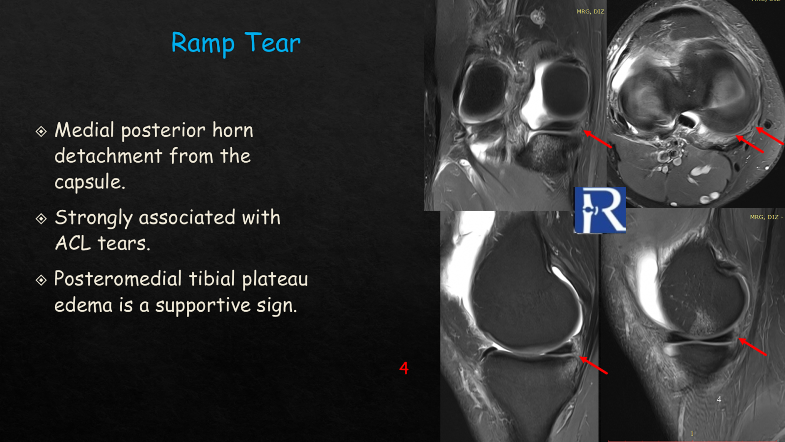 Meniscal Tears – Comprehensive MRI Guide